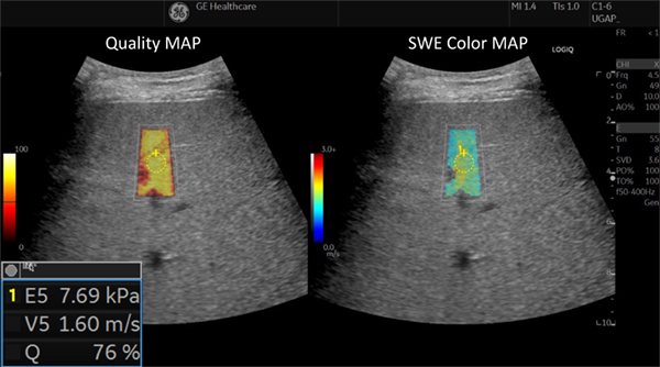 LOGIQ Fortis（腹部，表在，乳腺，甲状腺，循環器，血管，整形，皮膚科，小児科，産婦人科） - GEヘルスケア・ジャパン株式会社